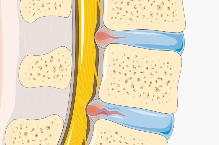 Disc Prolapse - GoodByePain